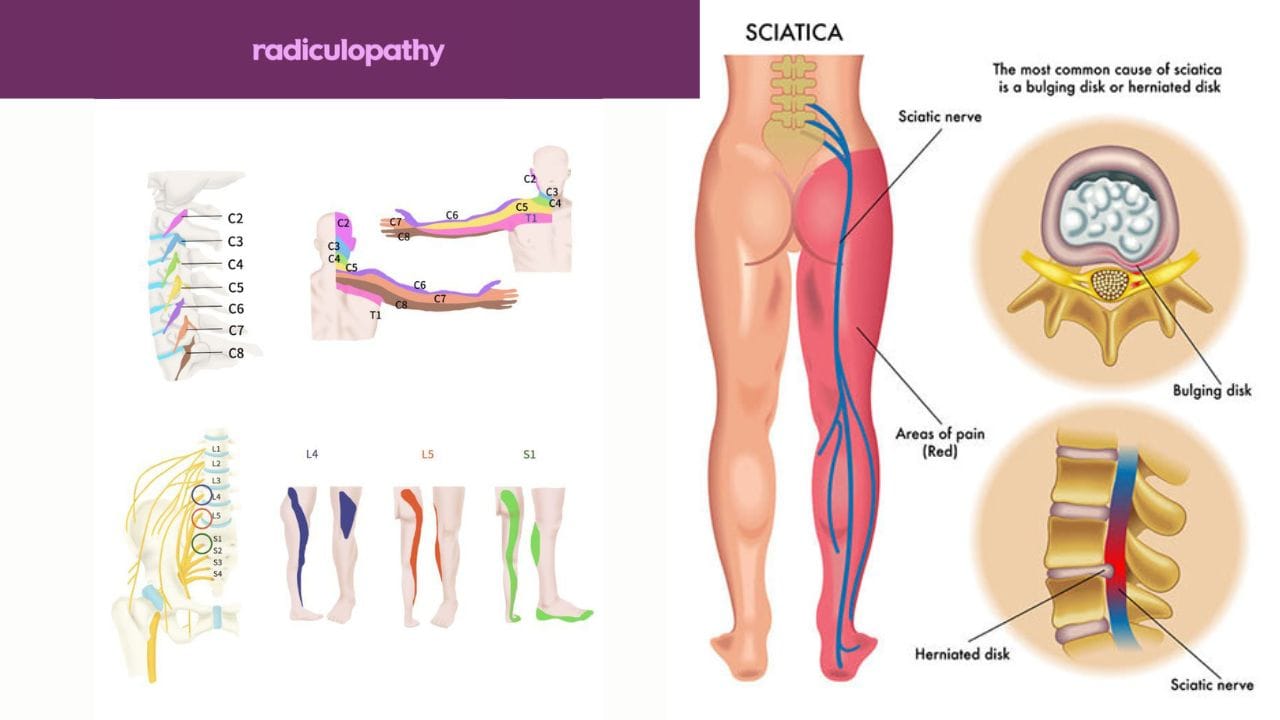 Sciatica vs. Radiculopathy: Diagnosis Causes & Treatments